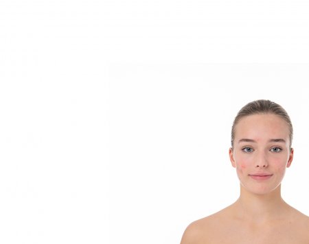 Understanding acne: Types, symptoms, causes and treatments | BIODERMA